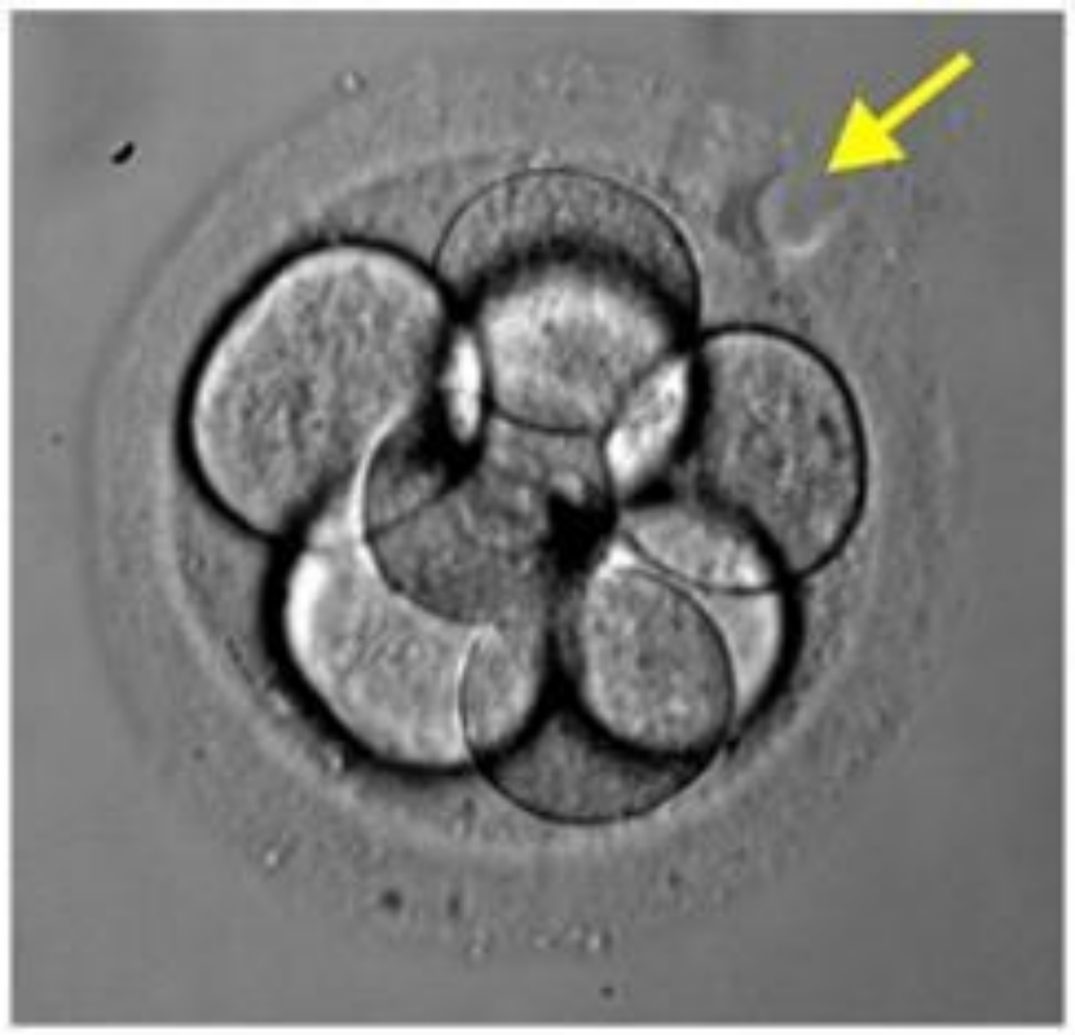 Laser Assisted Hatching (LAH) - Androcare Fertility Centre